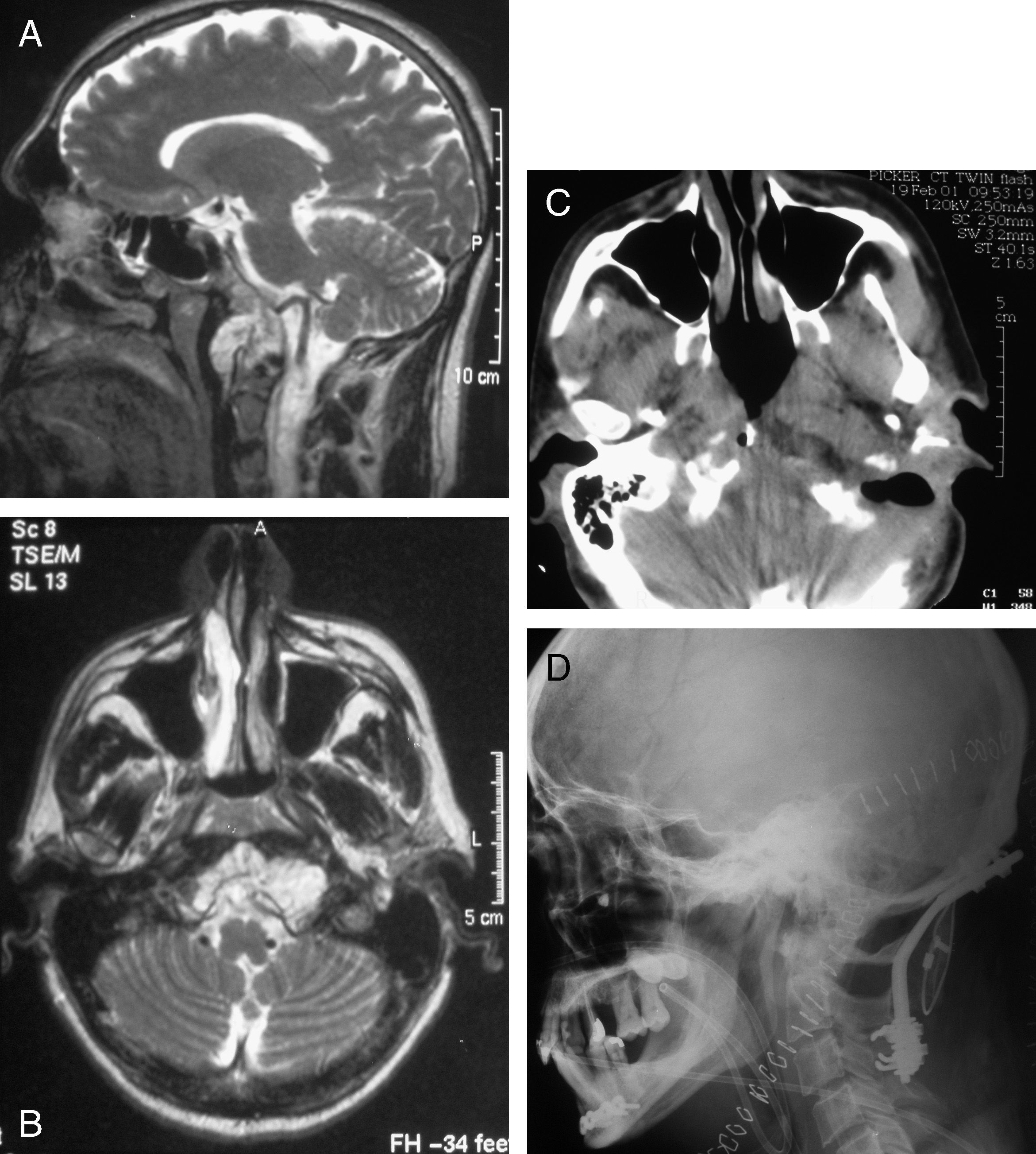 Tratamiento de los cordomas de clivus | Acta Otorrinolaringológica Española