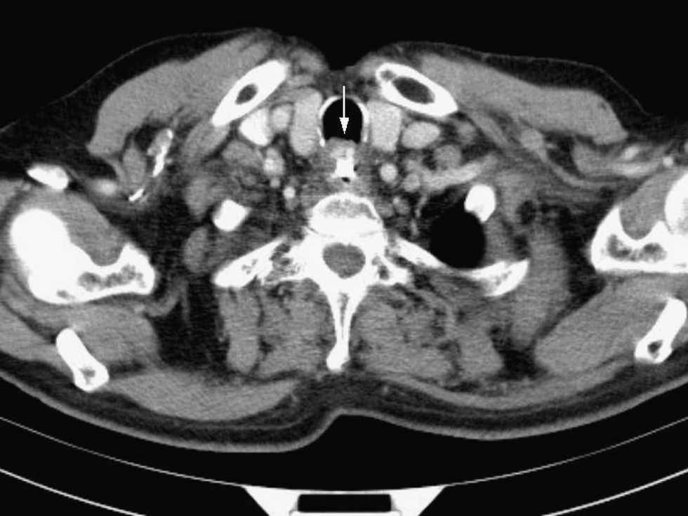 Incarceración total de prótesis fonatoria en la mucosa traqueoesofágica ...