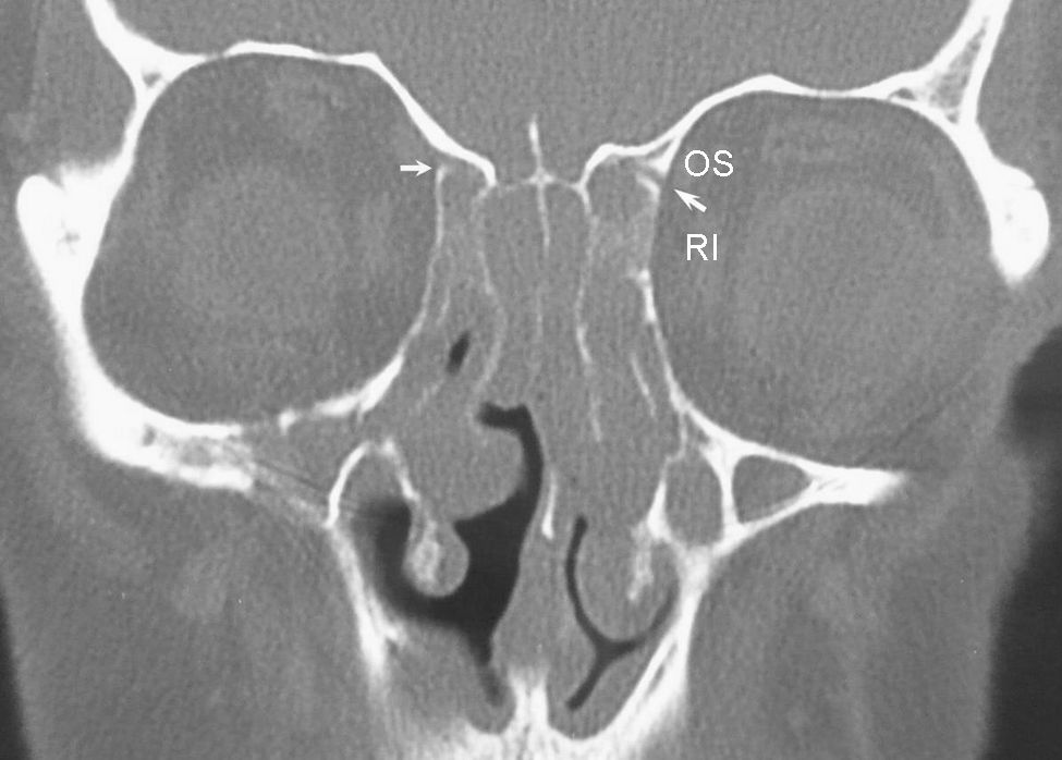 La arteria etmoidal anterior en el laberinto etmoidal: Revisión ...