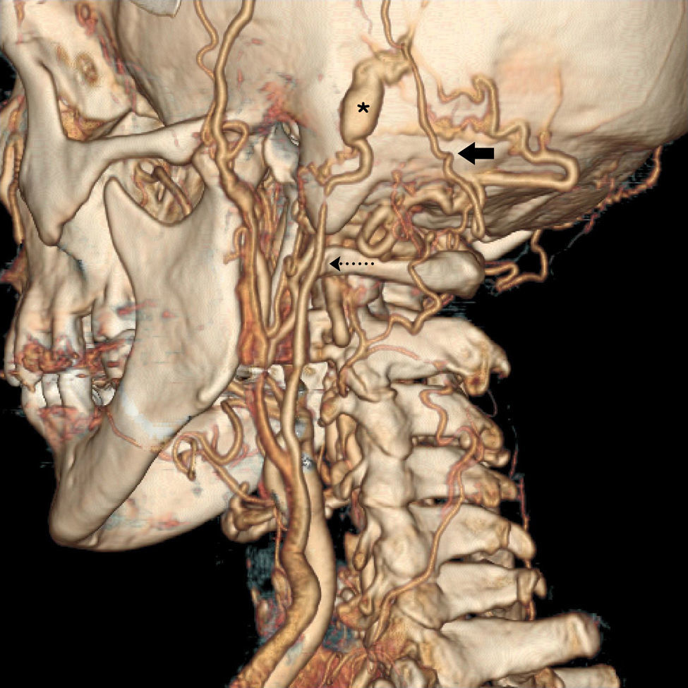 Fístula arteriovenosa retroauricular | Acta Otorrinolaringológica Española
