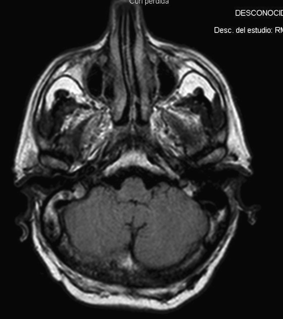 Síndrome de Ramsay-Hunt causante de parálisis laríngea | Acta ...