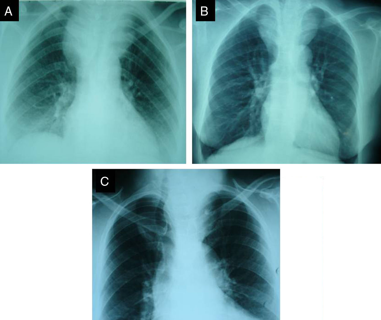 Tratamiento quirúrgico del bocio retroesternal: experiencia en un ...
