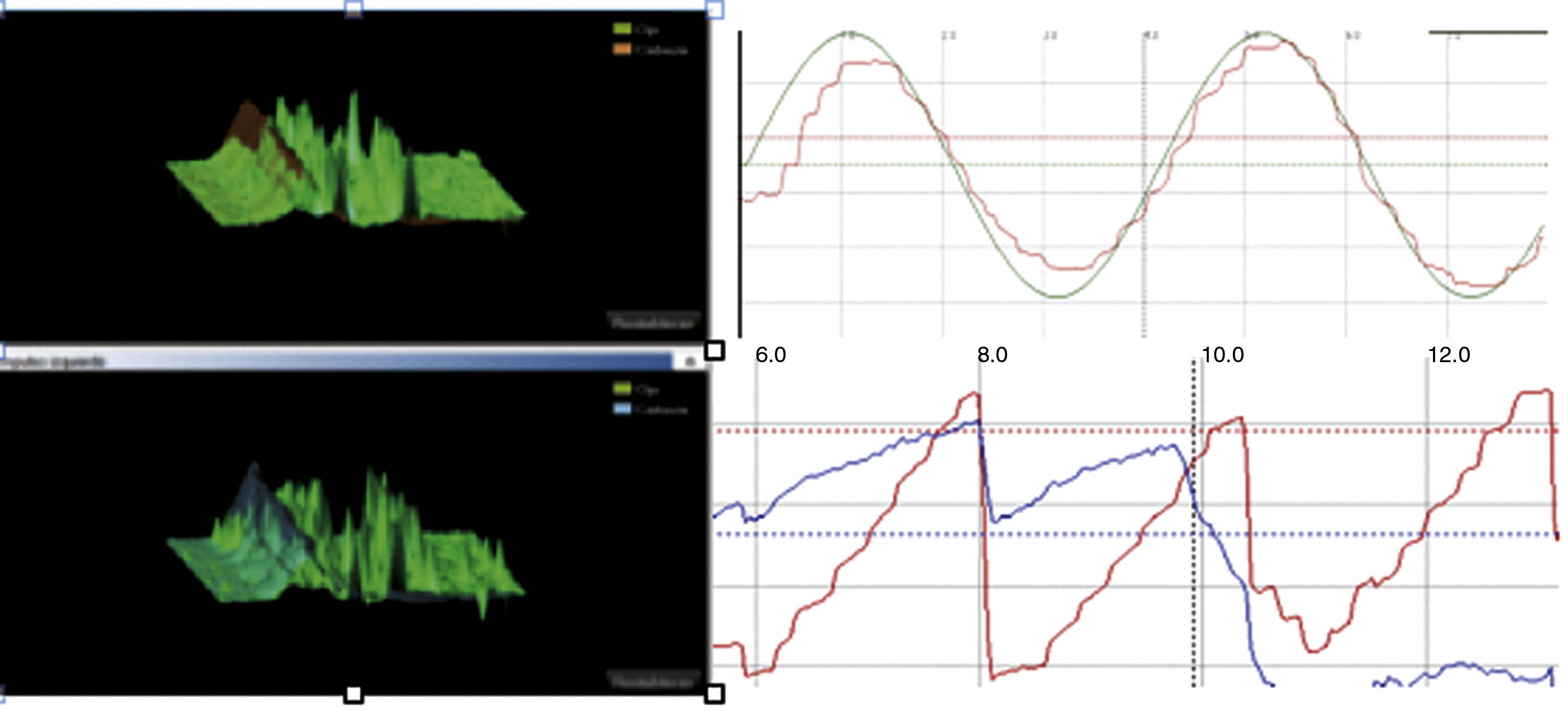 El síndrome de ataxia cerebelosa con neuropatía y arreflexia vestibular ...