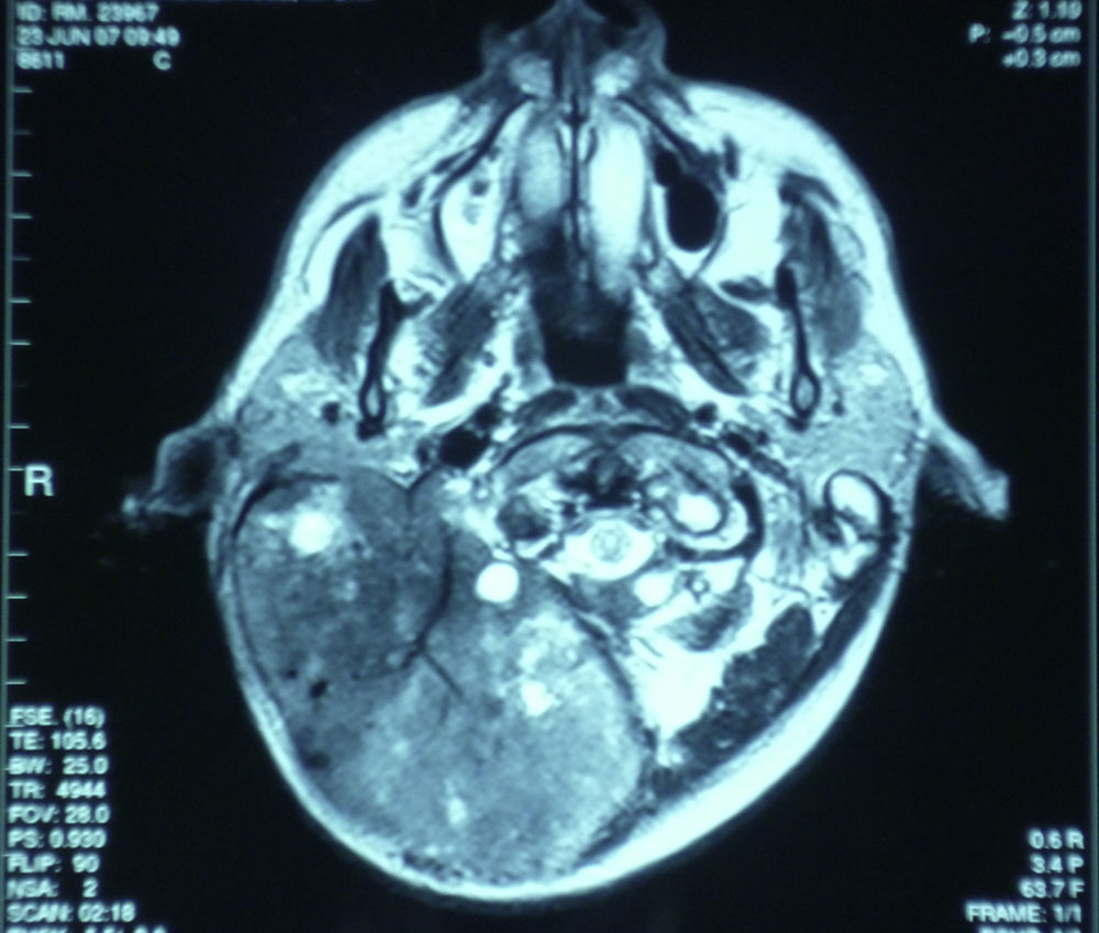 Encondroma de mastoides secundario a encondromatosis generalizada ...