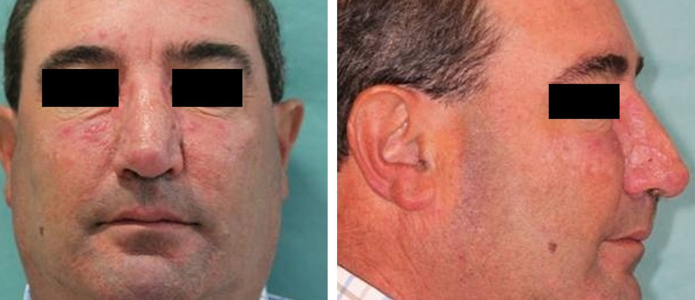 Láser CO2 en el tratamiento del rinofima | Acta Otorrinolaringológica ...
