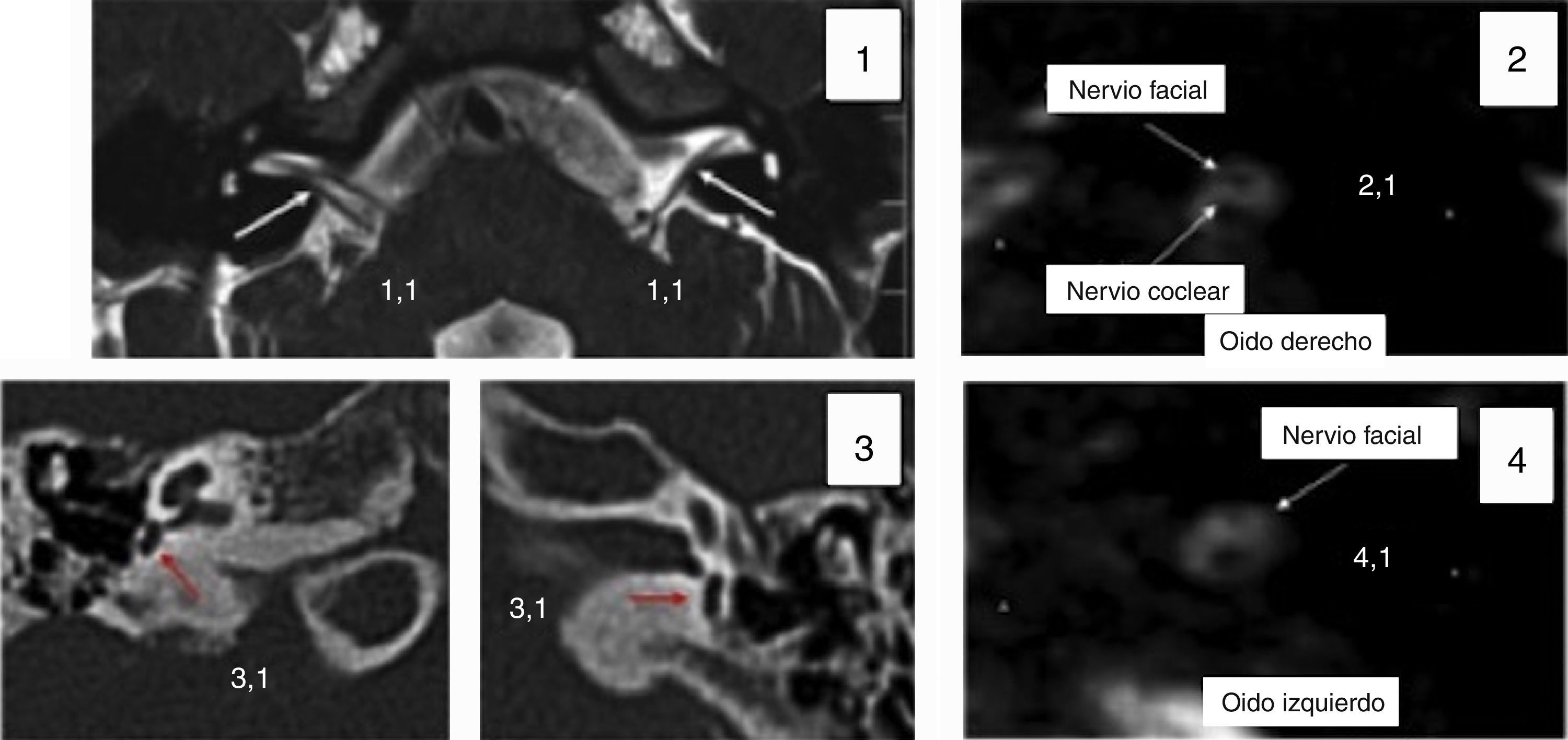 Malformaciones del octavo par en niños | Acta Otorrinolaringológica ...