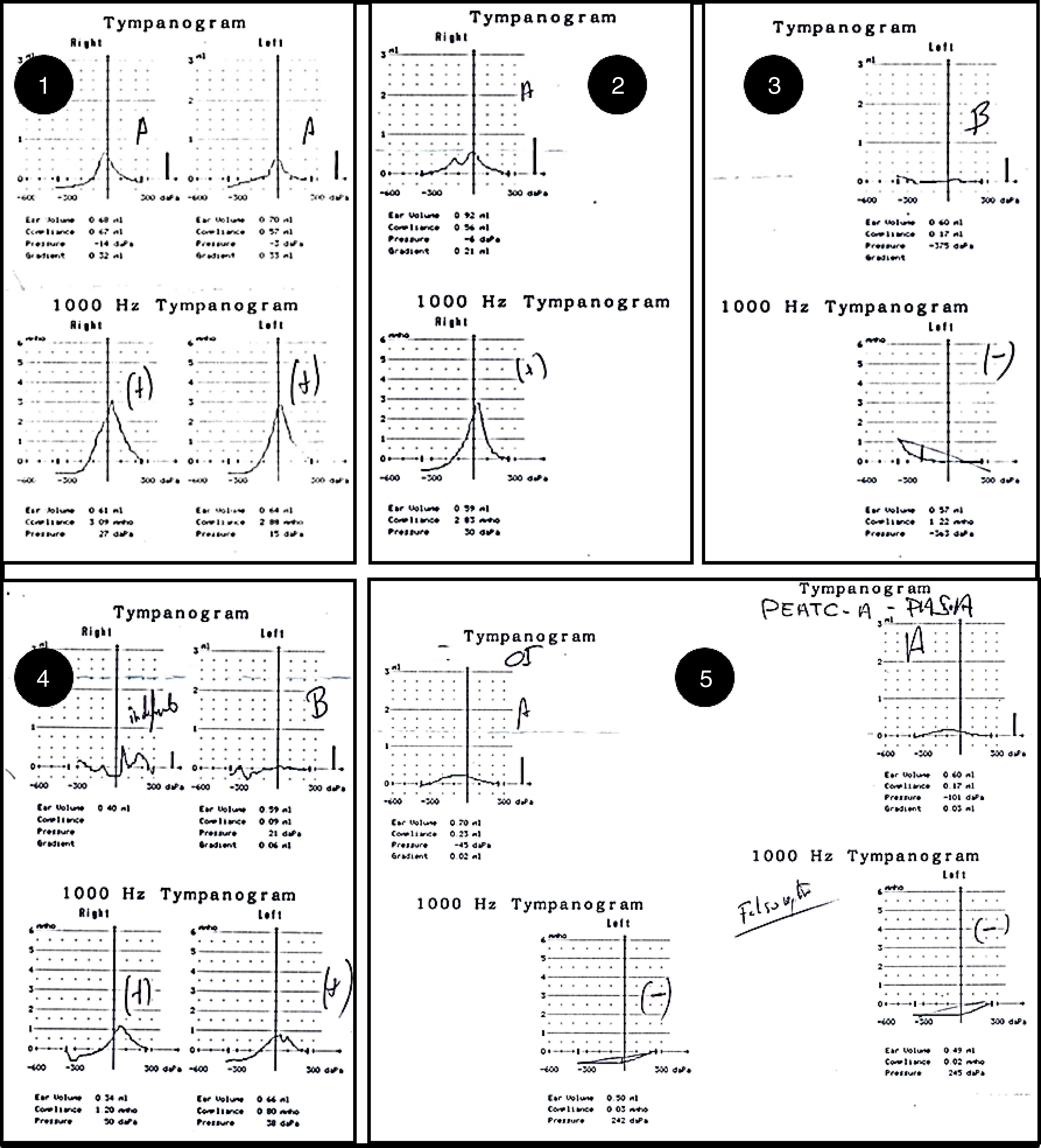 Timpanometría de alta frecuencia (1.000Hz) en lactantes y su ...