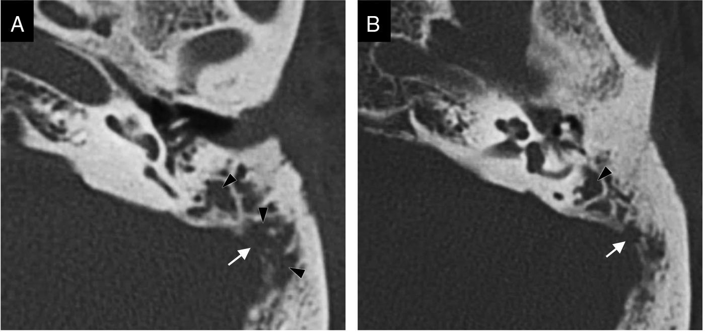 Indicaciones y hallazgos radiológicos de la otitis media aguda y sus ...
