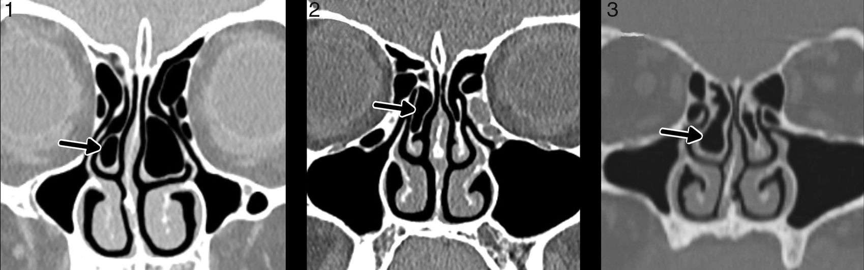 Concha bullosa. A radiological study and a new classification | Acta ...