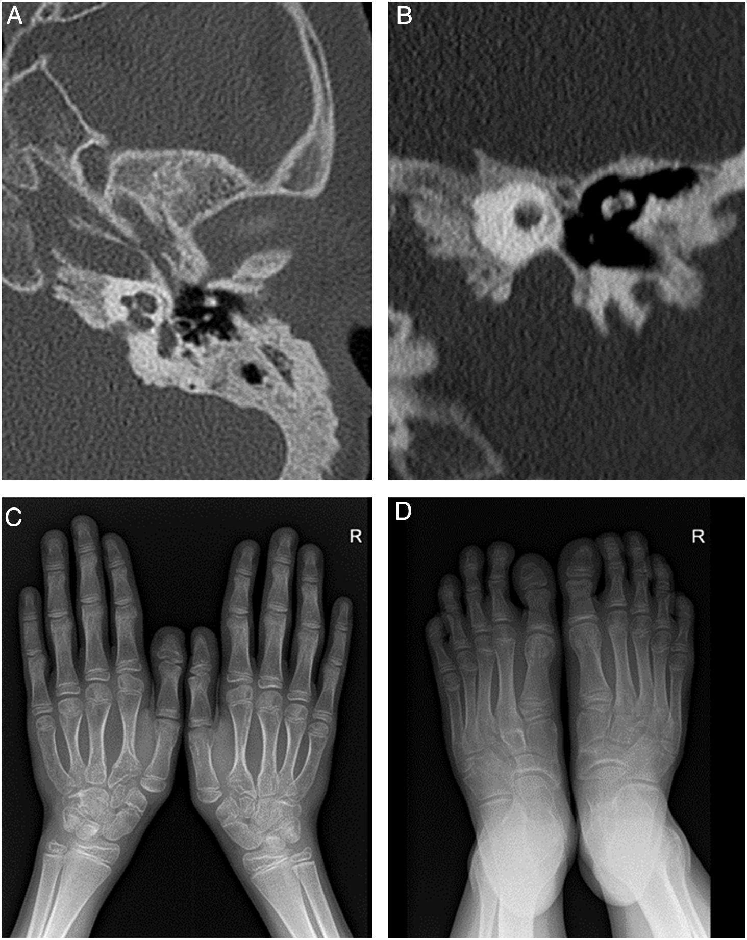 Otopalatodigital syndrome type I: New temporal bone CT-scan sign in a ...