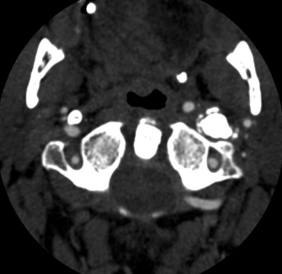 A long styloid process and Collet–Sicard syndrome | Acta ...