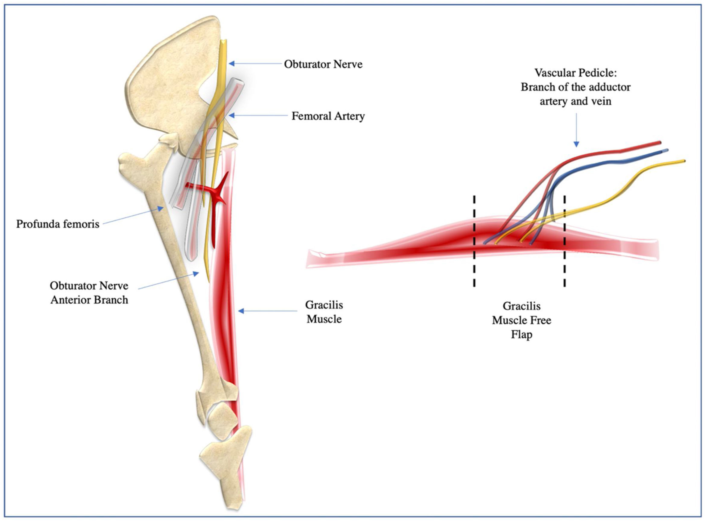 Gracilis free flap in head and neck reconstruction beyond facial palsy ...