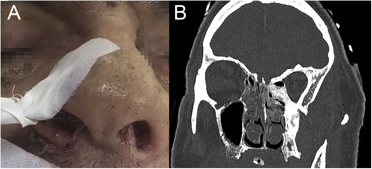 Nasal myiasis in a Spanish intensive care unit | Acta ...
