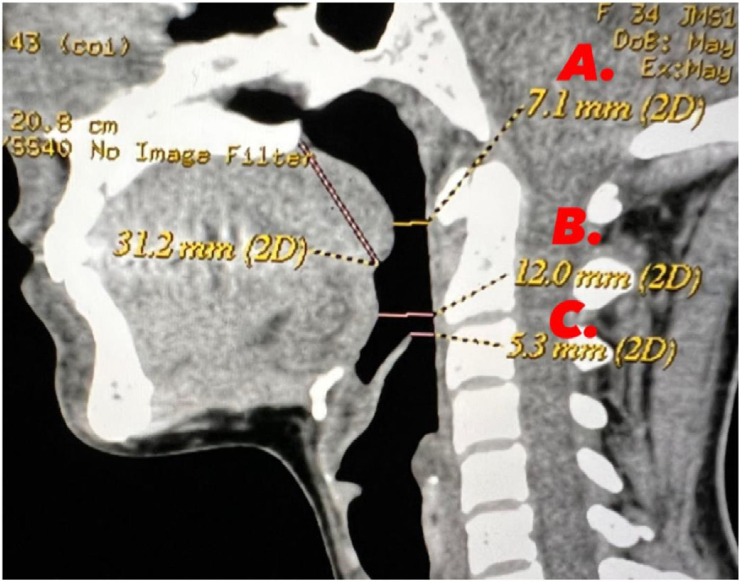 Upper Airway Assessment In Obstructive Sleep Apnea Patients Can