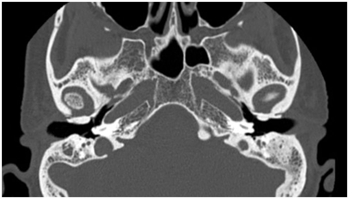 Osteomas de conducto y promontorio. Hipoacusia bilateral | Acta ...