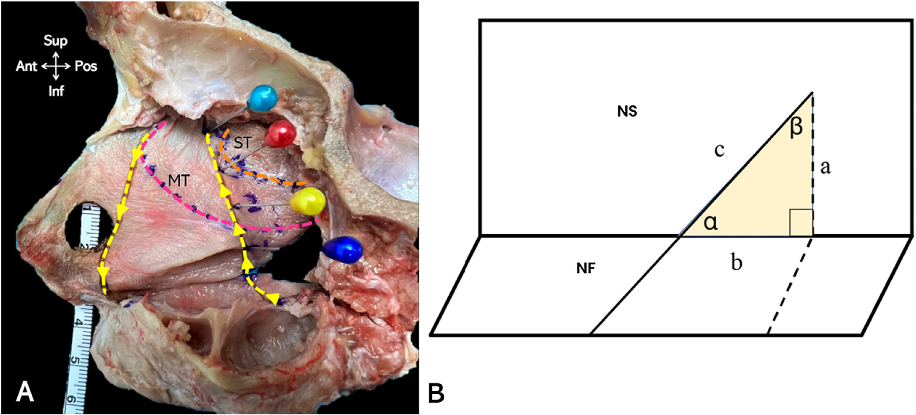 Enhancing the coverage and rotation of anterior ethmoidal artery flap ...