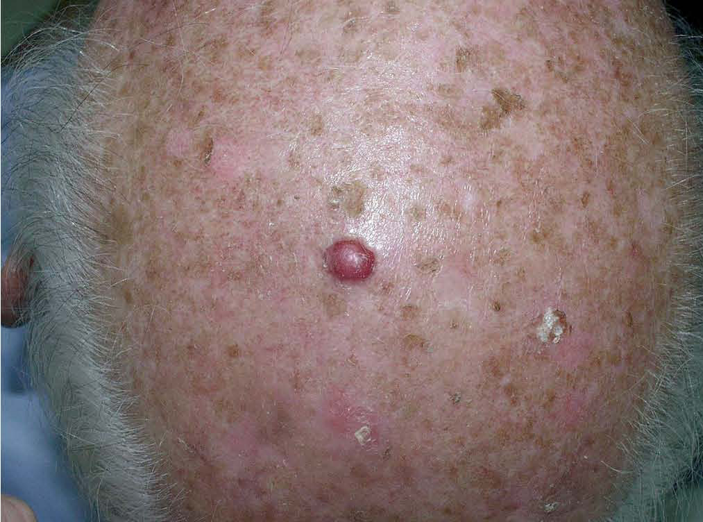 Fibroxantoma atípico. Estudio clinicopatológico de 10 casos