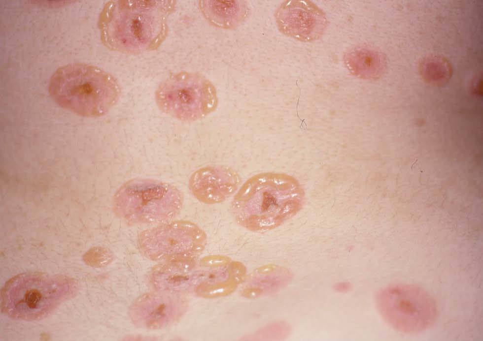 Dermatosis ampollosa IgA lineal del adulto tratada con colchicina
