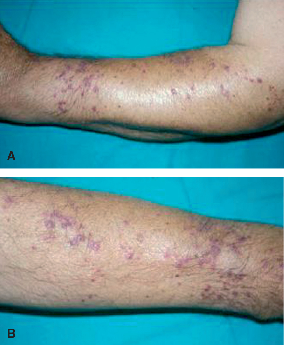 Pseudosarcoma de Kaposi bilateral en miembros superiores