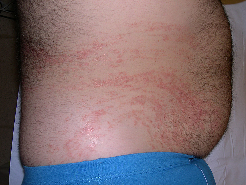 Blaschkitis del adulto (liquen estriado) en paciente tratado con adalimumab