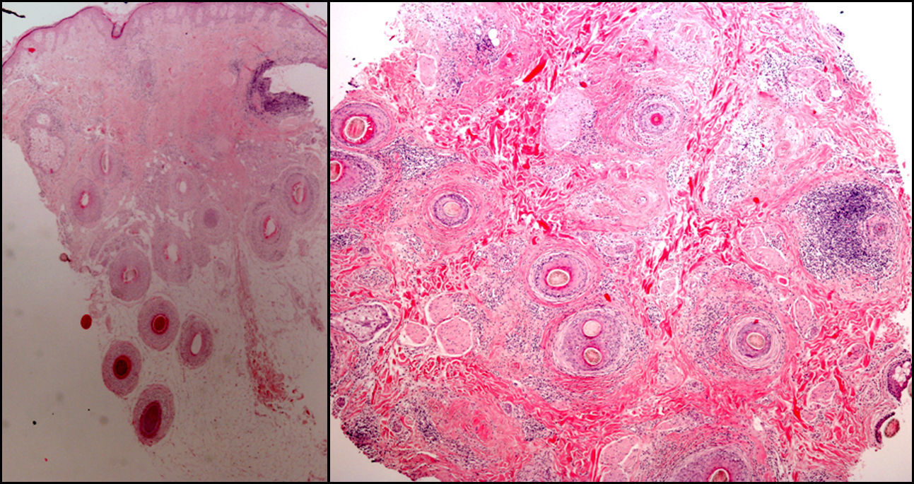 La biopsia cutánea: bases fundamentales. Parte II | Actas Dermo ...