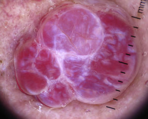 Vascularización en dermatoscopia | Actas Dermo-Sifiliográficas