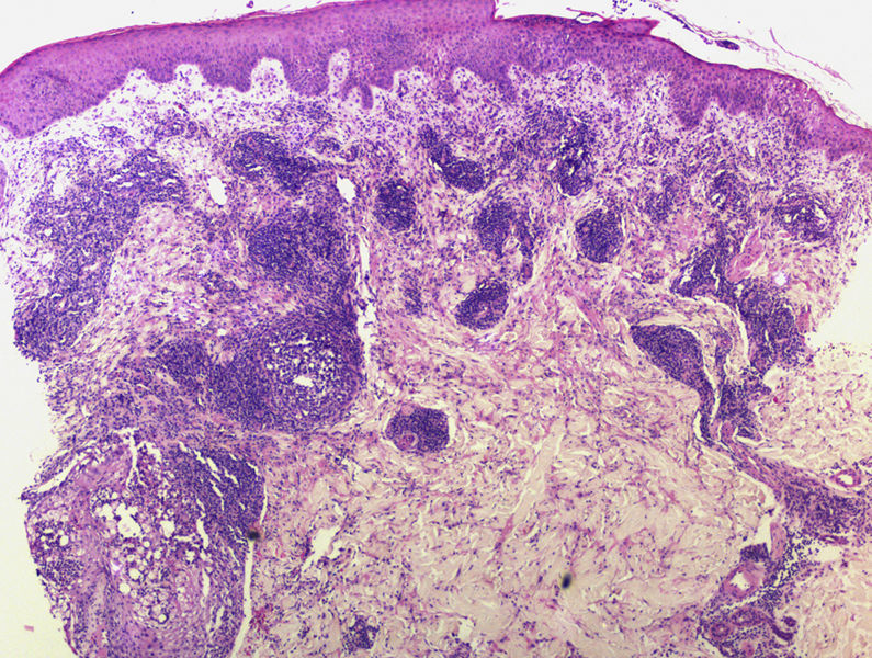 tinea faciei under microscope