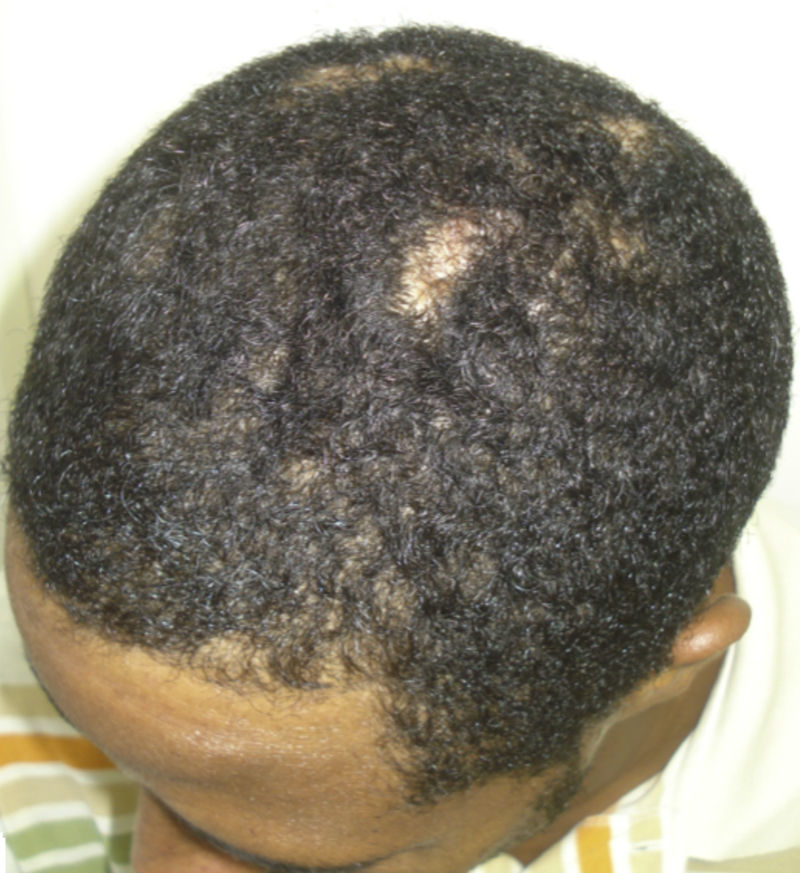 scalp cellulitis