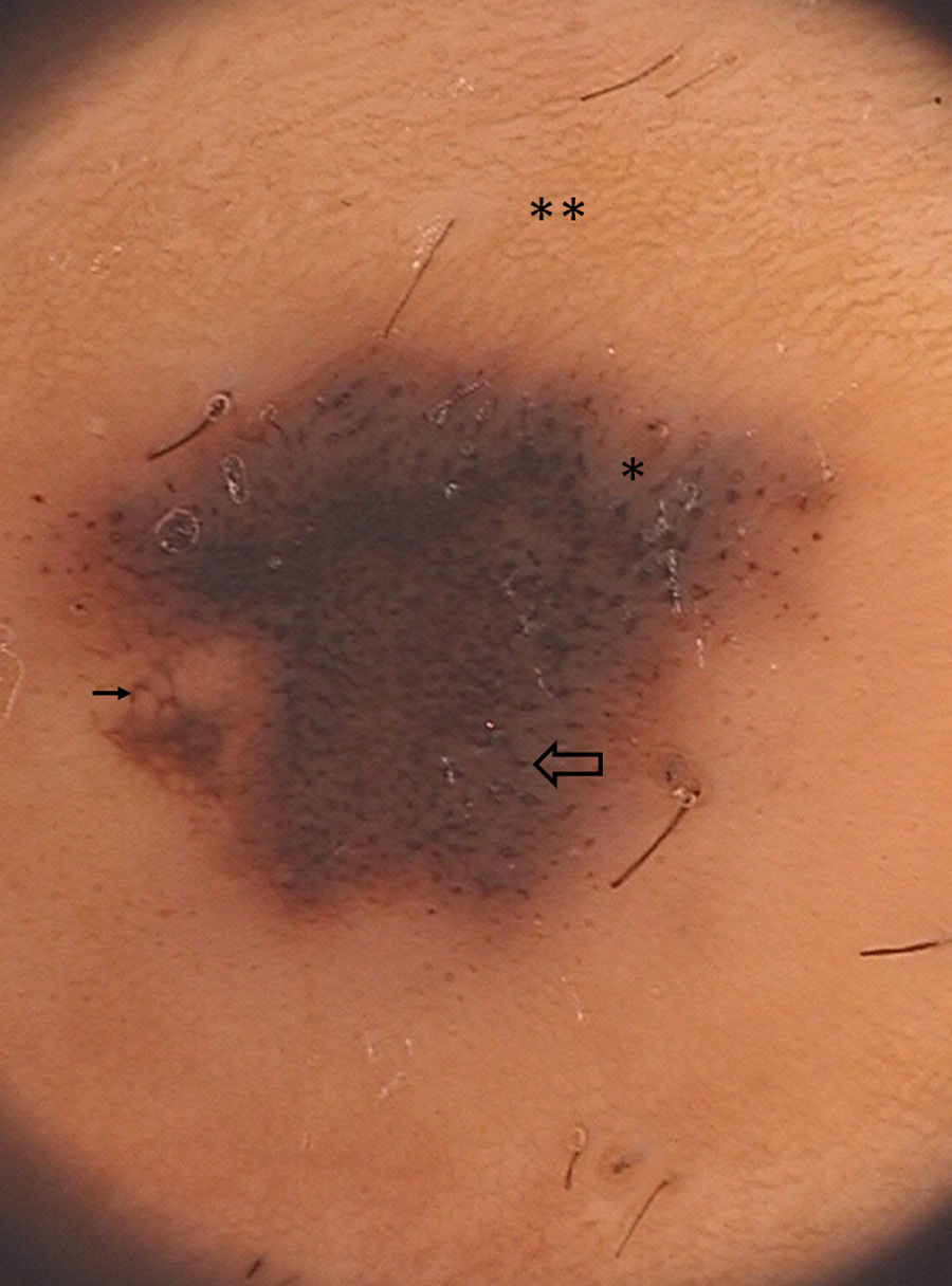Large Asymmetric Pigmented Nodule in a 27-Year-Old Female | Actas Dermo ...