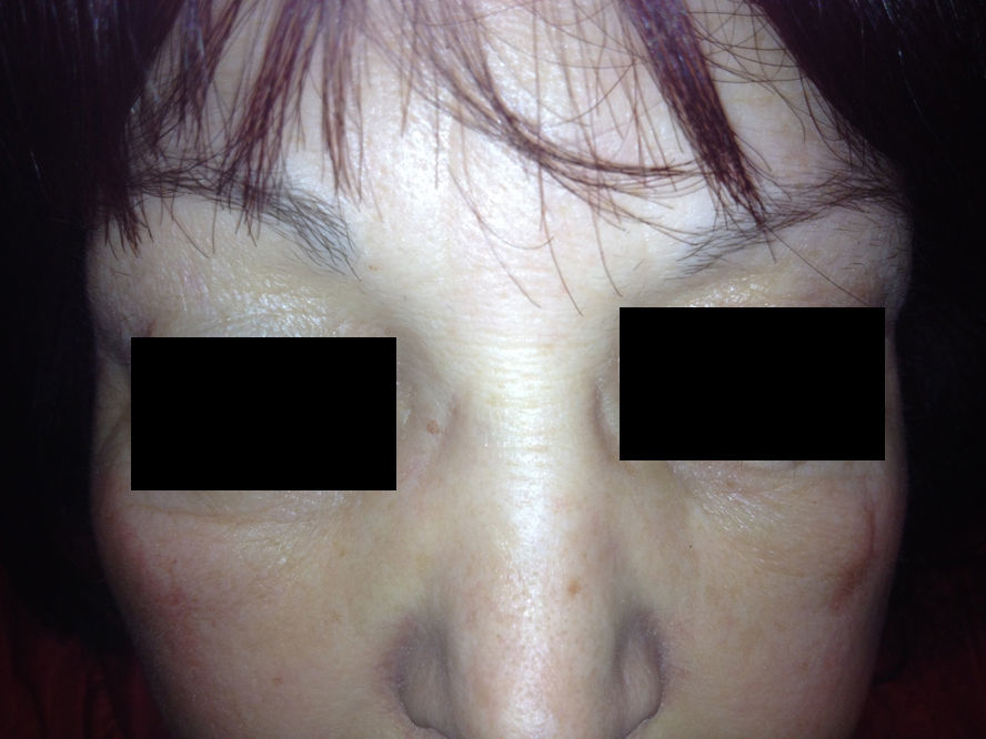 Edema palpebral bilateral asociado a crisis hipotiroidea | Actas Dermo ...