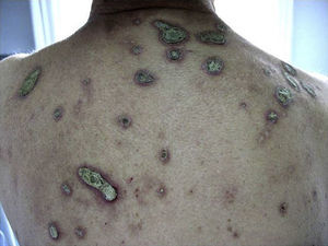 Dermatosis perforante adquirida: presentación de 8 casos | Actas Dermo ...