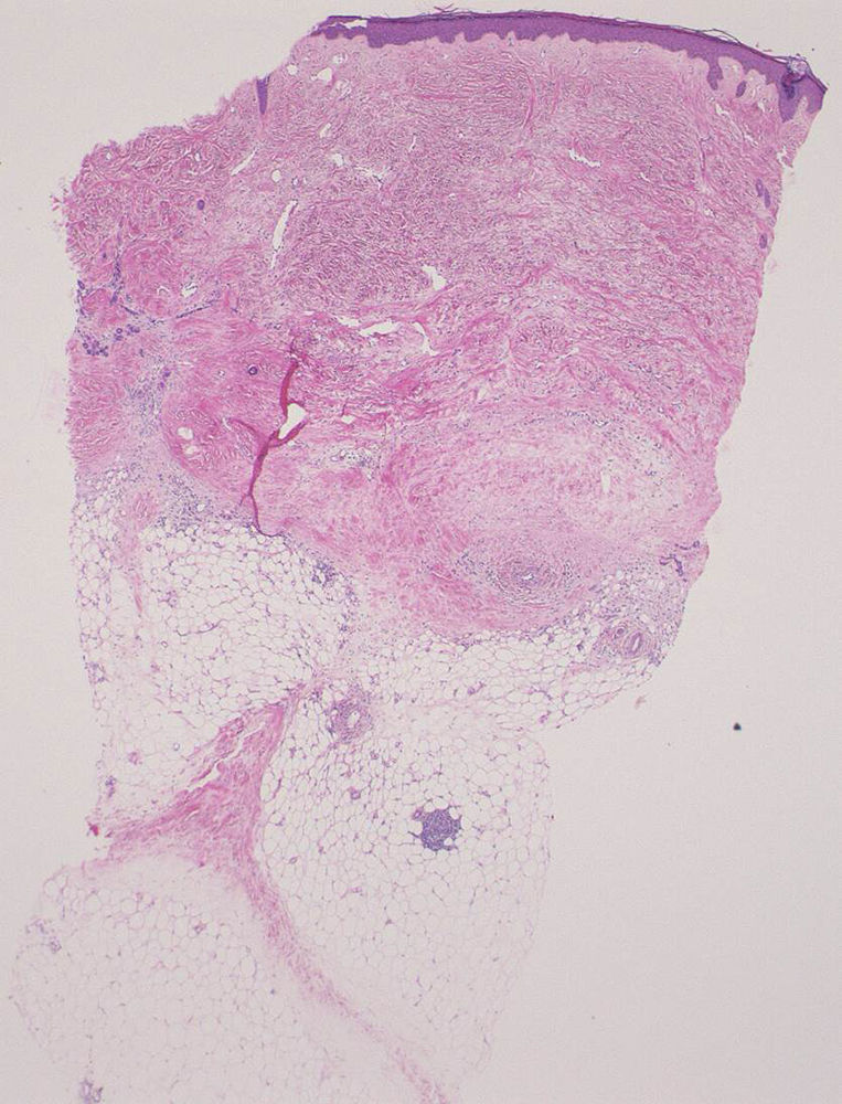 Pediatric generalized morphea that developed at a BCG vaccination site