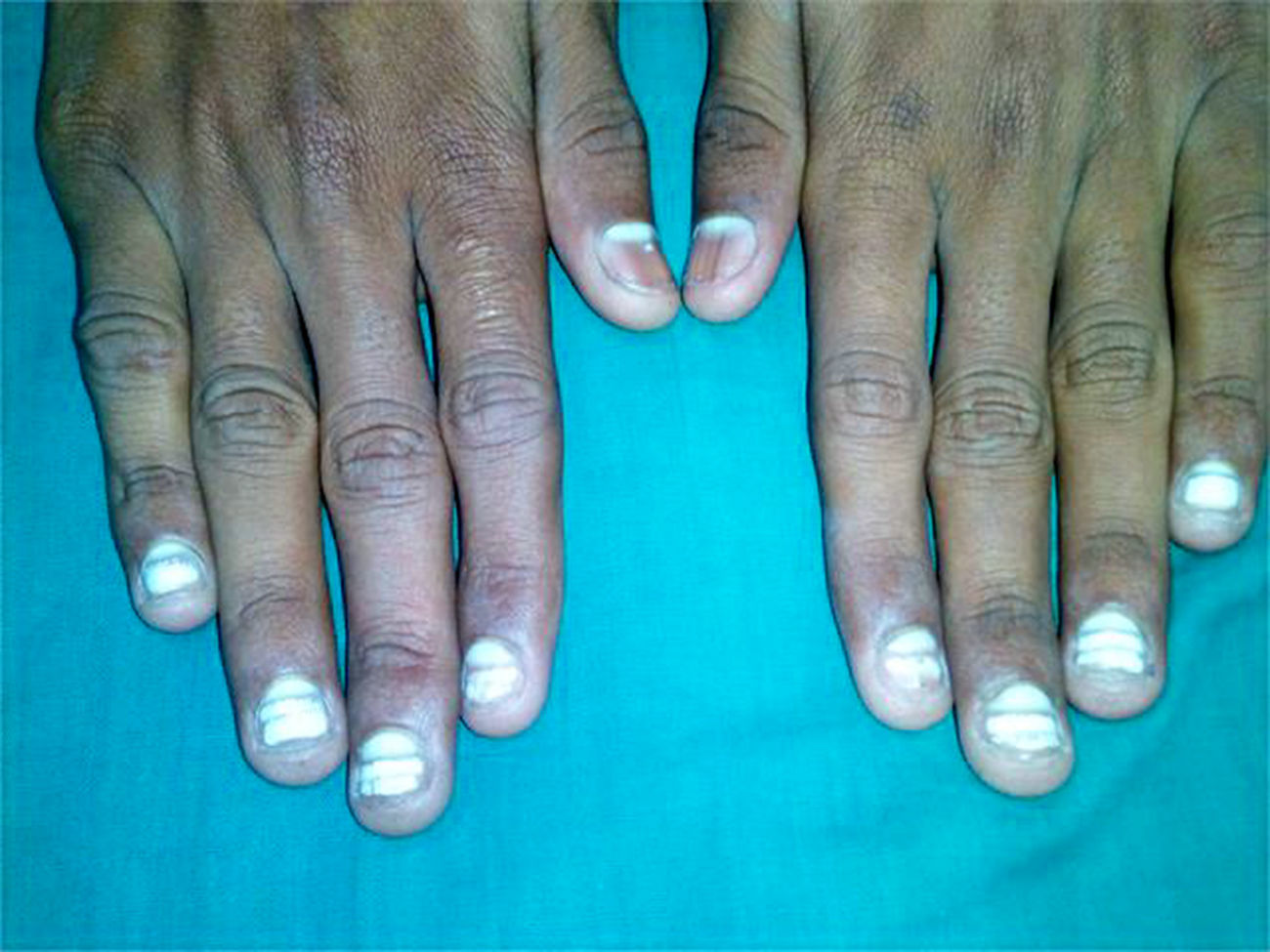 leukonychia description