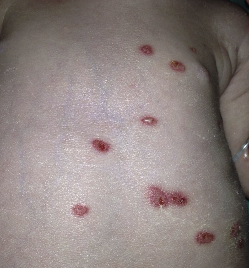 neonatal herpes simplex