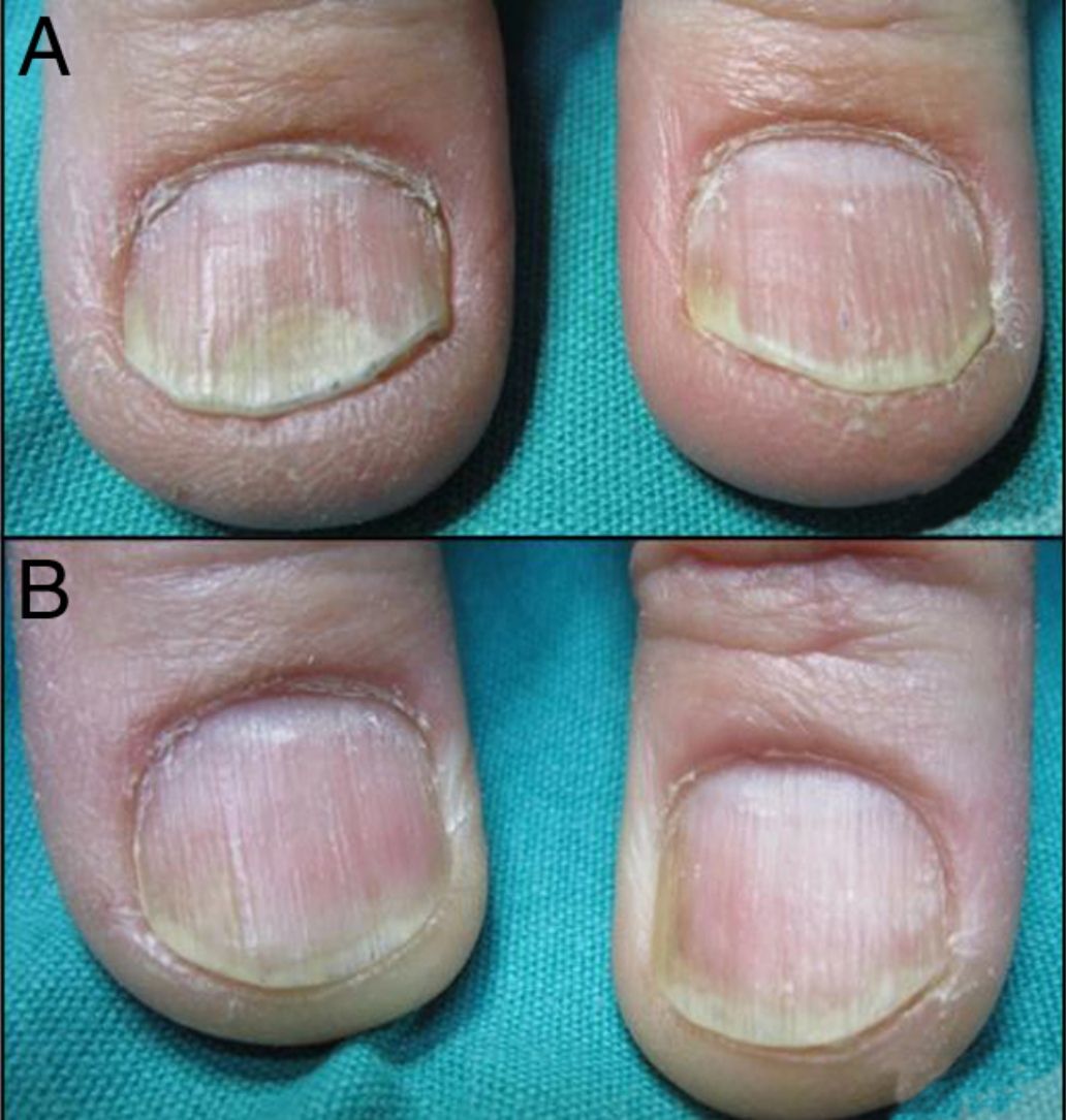 Treatment of nail psoriasis with Pulse Dye Laser plus calcipotriol ...