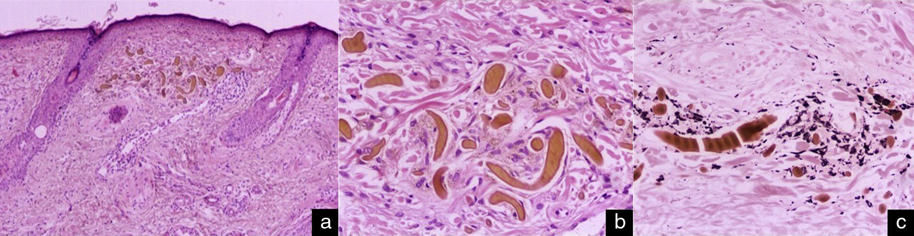 Ocronosis exógena en melasma facial | Actas Dermo-Sifiliográficas