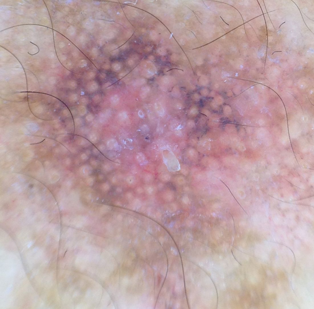 actinic keratosis dermoscopy