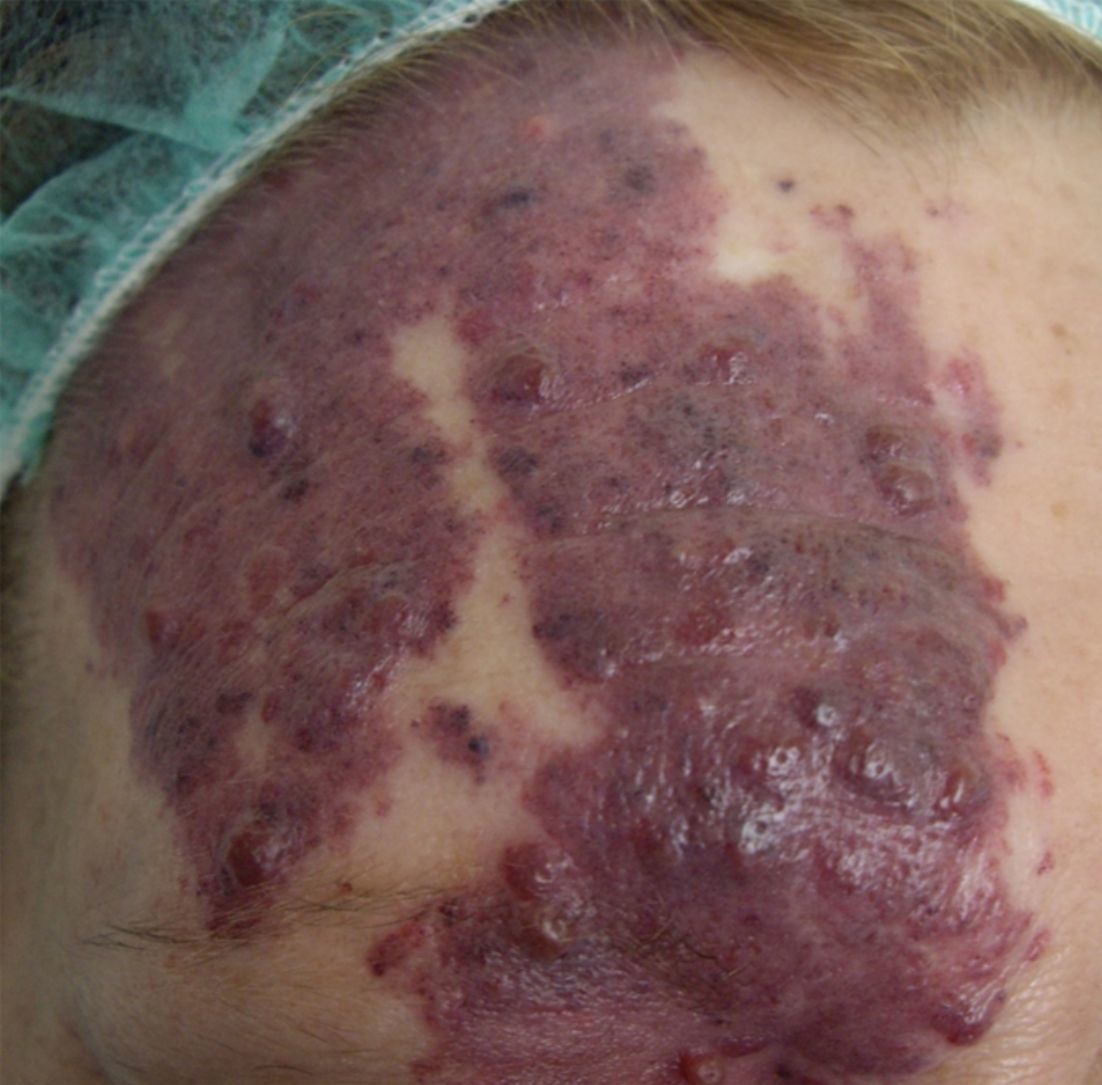 Malformaciones capilares tratadas con aplicación secuencial de láser de ...