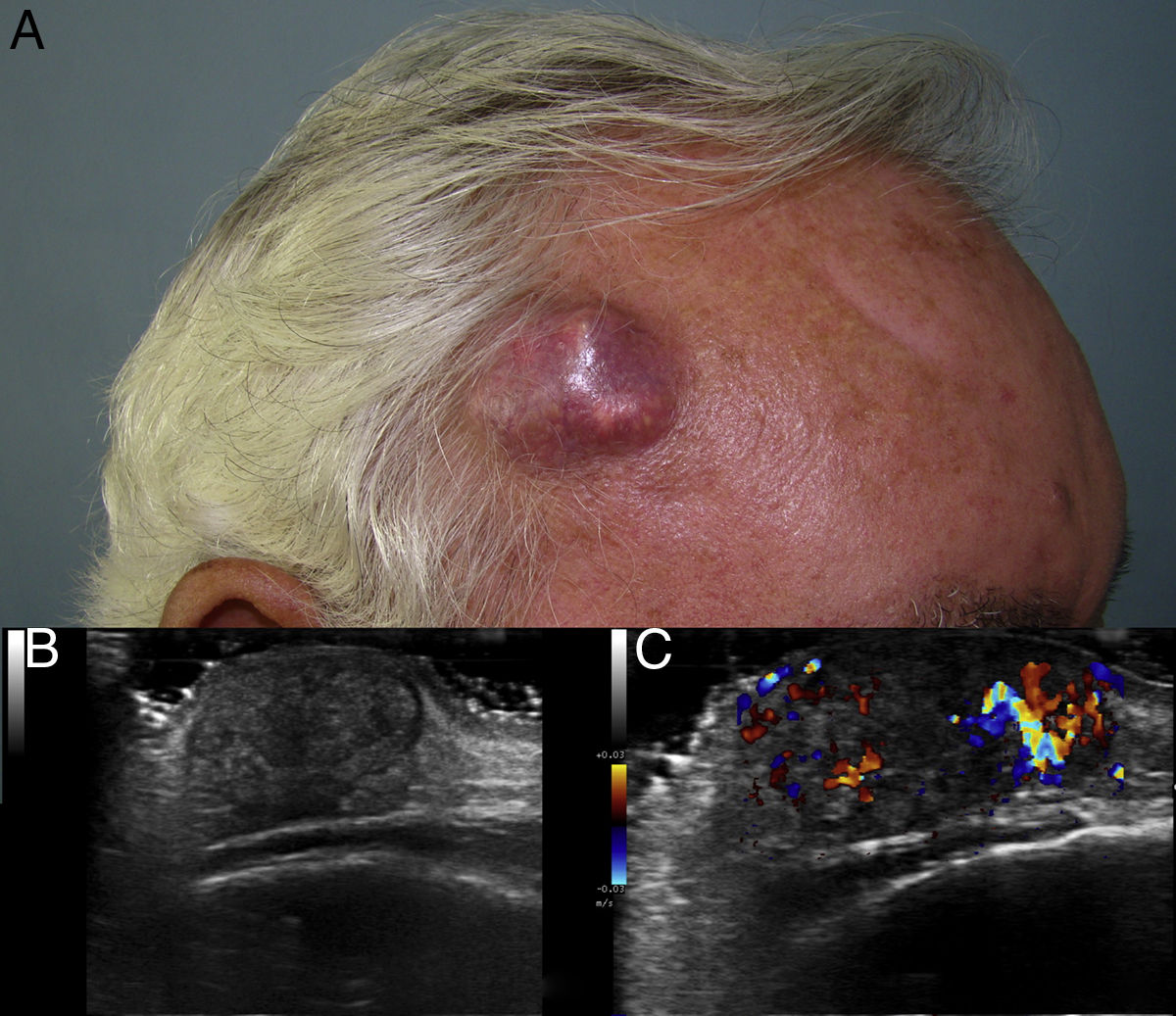 Pilomatrixoma proliferante simulando malignidad | Actas Dermo ...