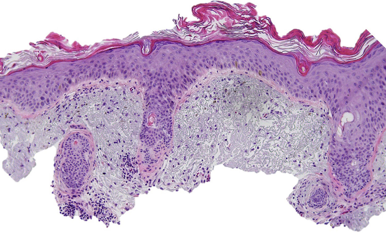 Inflamación de queratosis actínicas durante el tratamiento con ...
