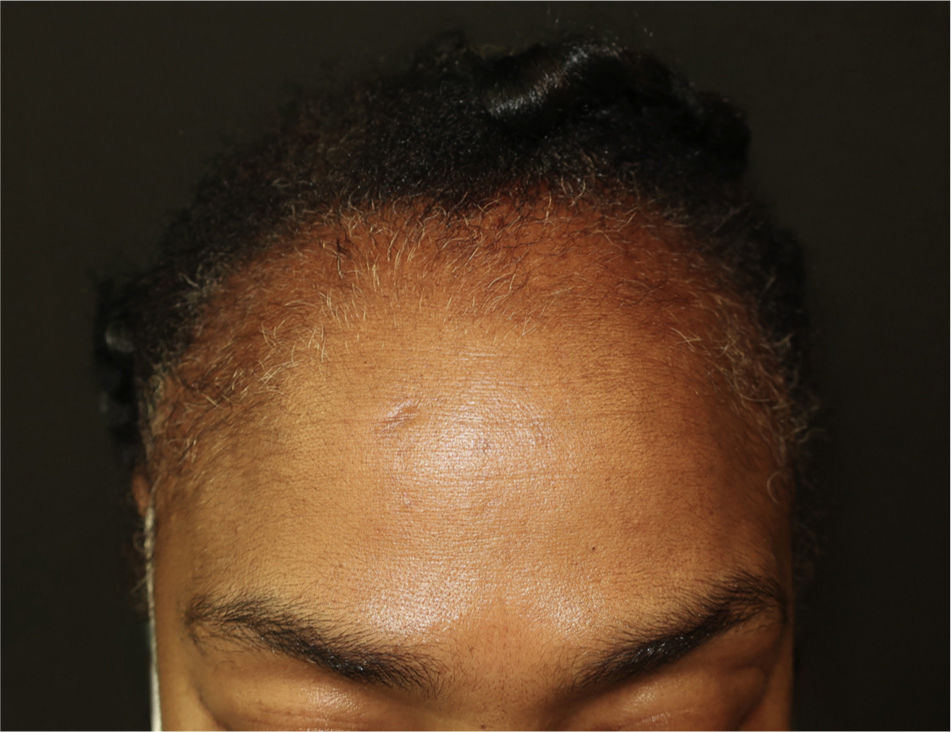 Hair Casts: Trichoscopic Clues | Actas Dermo-Sifiliográficas