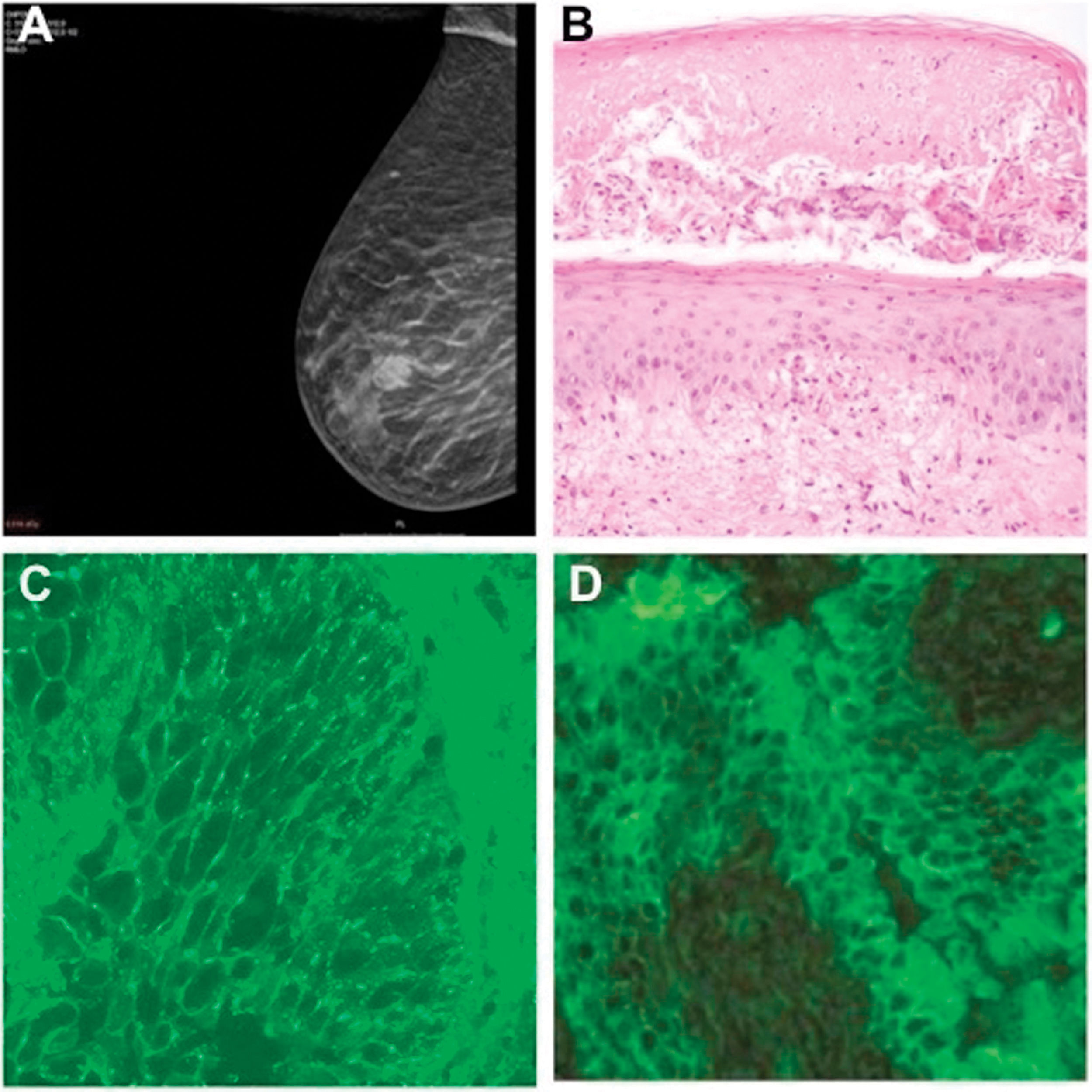 [Translated article] Atypical Paraneoplastic Pemphigus Without Mucosal ...