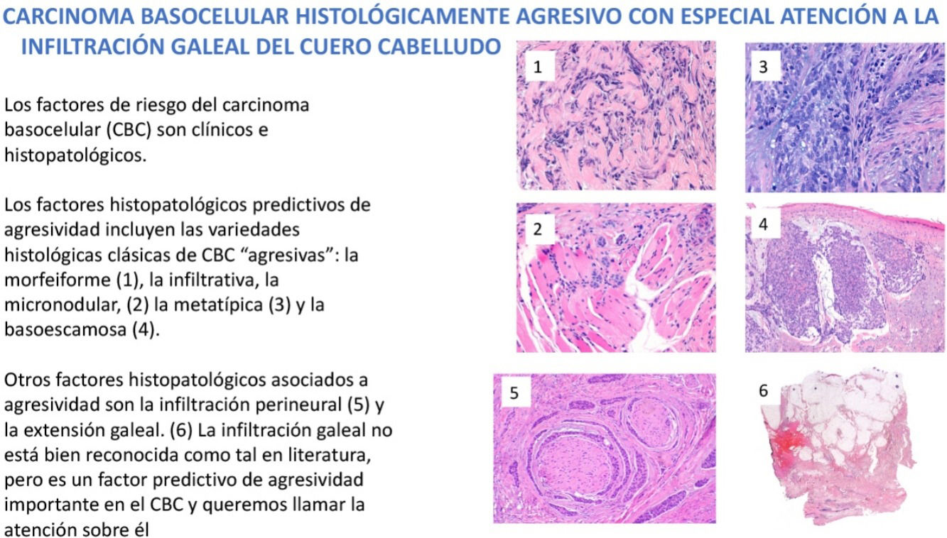 [Translated article] Histologically agressive basal cell carcinoma with ...