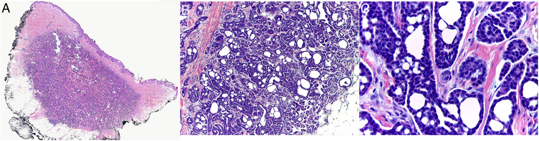 Carcinoma cribiforme cutáneo primario | Actas Dermo-Sifiliográficas