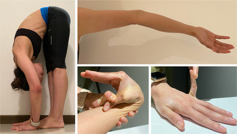 equimosis espontanea