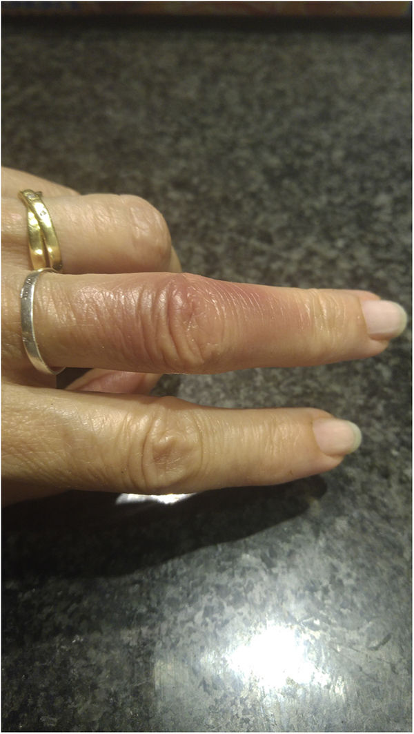 equimosis espontanea