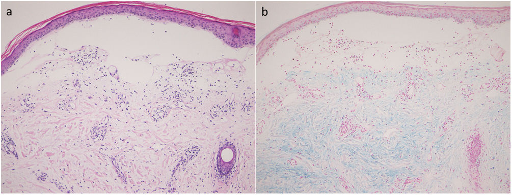 Vesiculo-bullous Dermatomyositis in Association with Internal ...