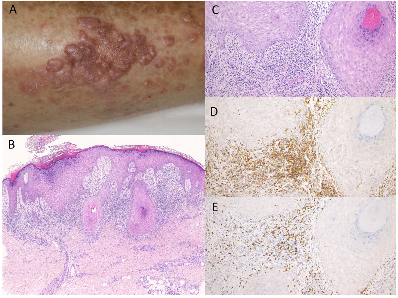 bullous lichen planus code