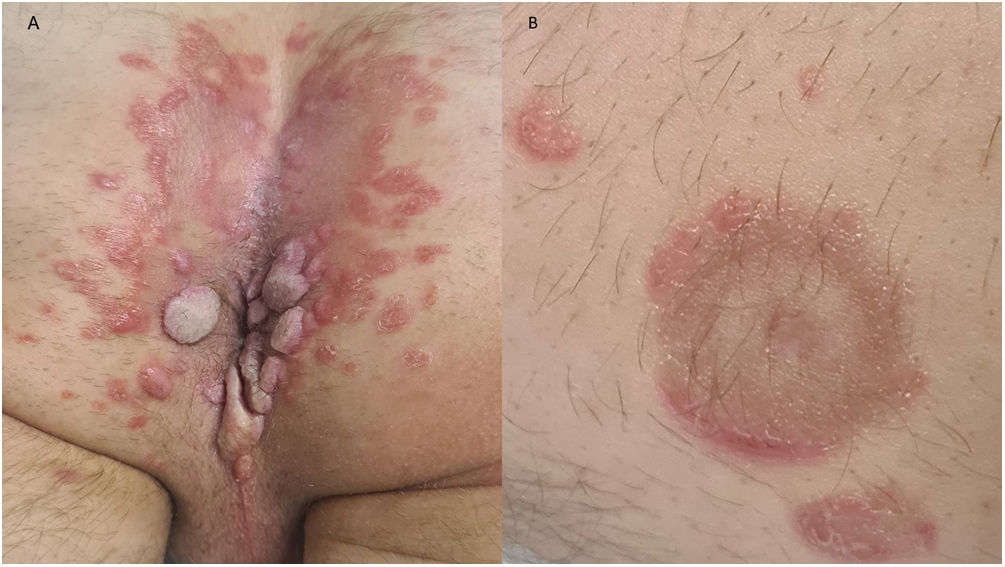 collarette scale syphilis