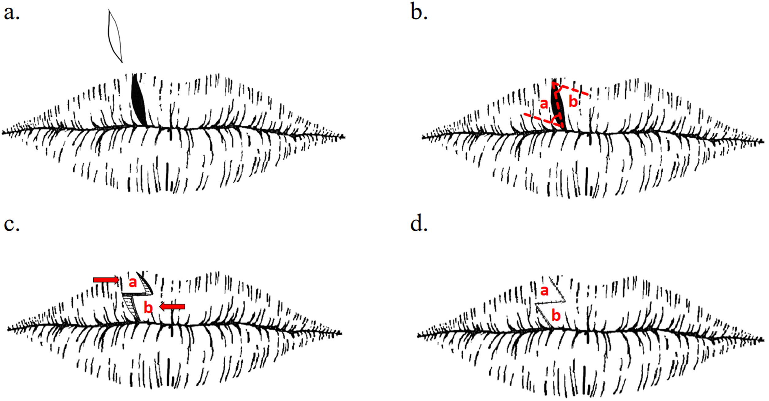 [Translated article] Surgical Treatment of Chronic Lip Fissure with Z ...